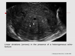 Sonography of adenomyosis | PPT