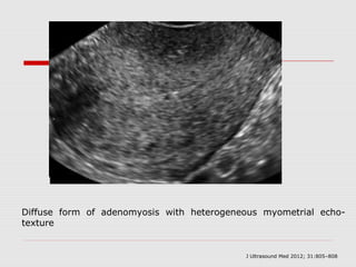 Sonography of adenomyosis | PPT