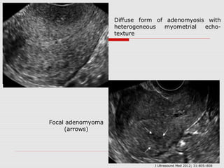 Sonography of adenomyosis | PPT