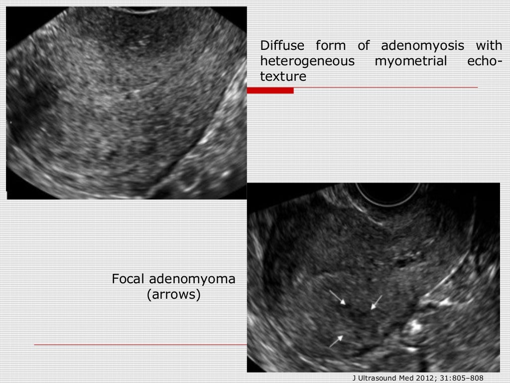 Sonography Of Adenomyosis