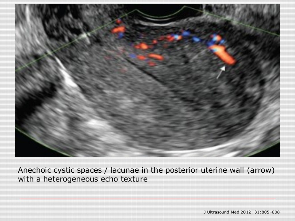 Sonography Of Adenomyosis