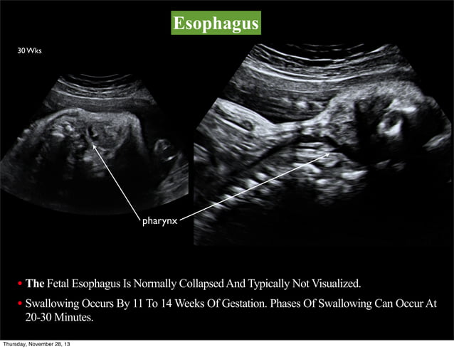 Sonography of fetal GIT | PDF
