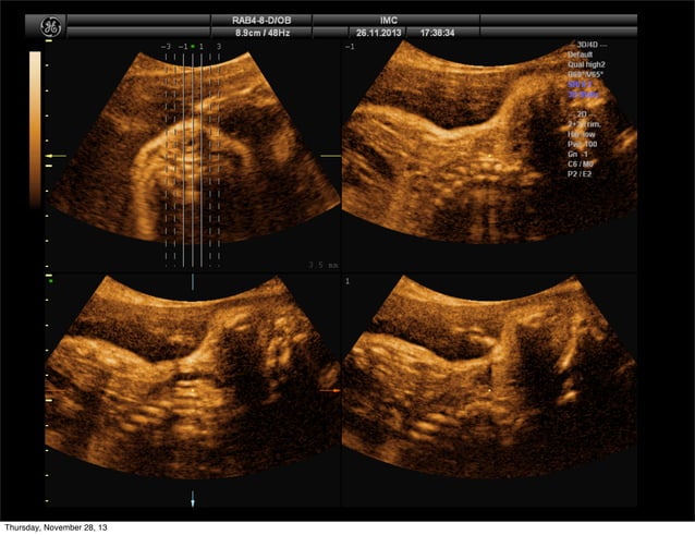 Sonography of fetal GIT | PDF