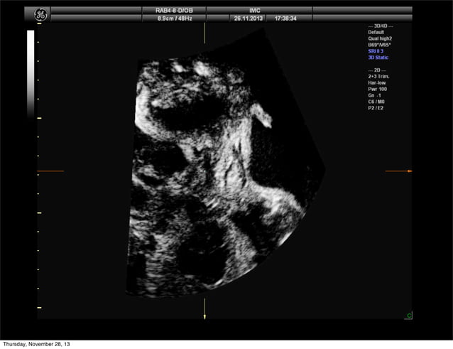 Sonography of fetal GIT | PDF