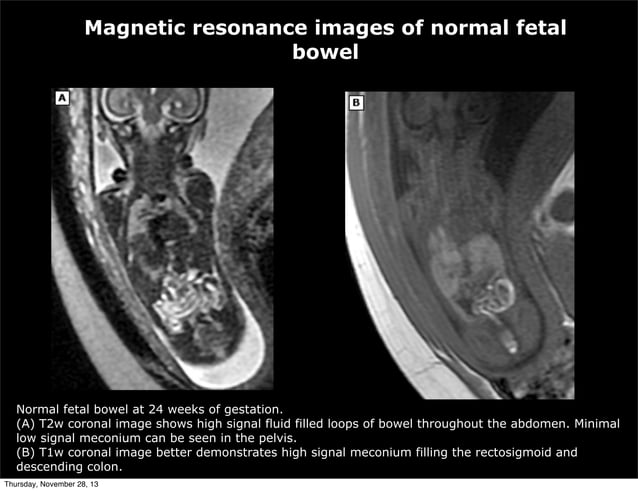 Sonography of fetal GIT | PDF