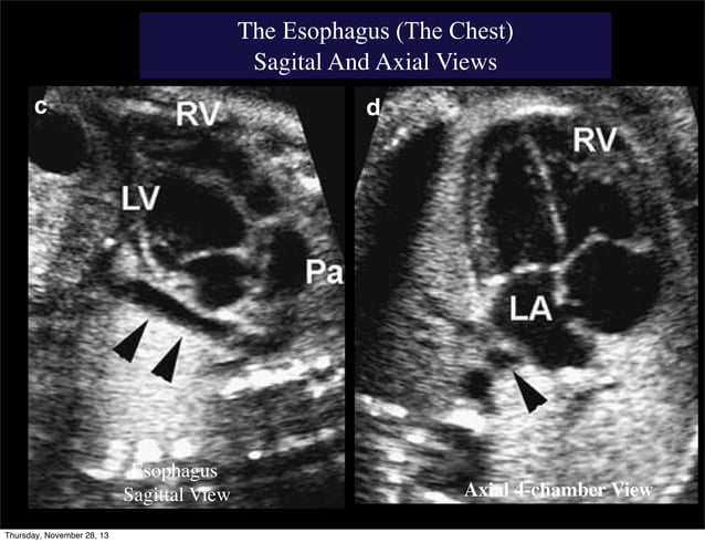 Sonography of fetal GIT | PDF