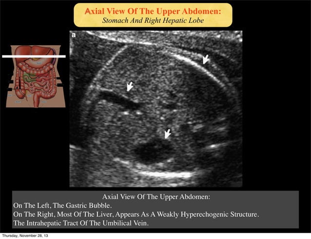 Sonography of fetal GIT | PDF