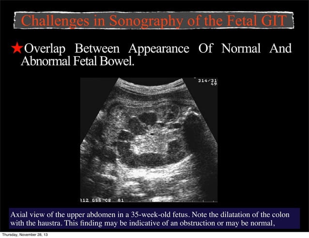 Sonography of fetal GIT | PDF