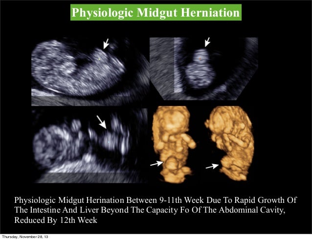 Sonography of fetal GIT