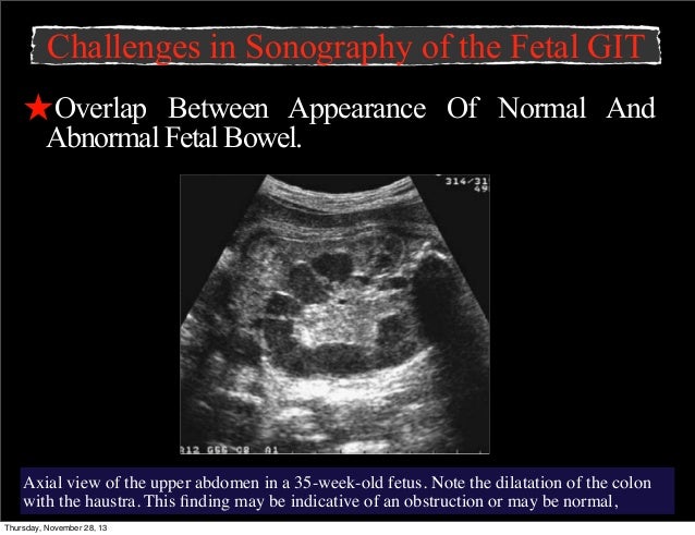 Sonography of fetal GIT