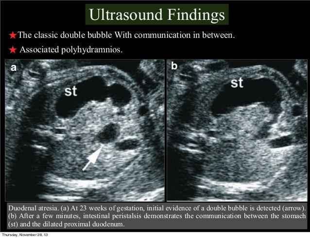 Sonography of fetal GIT