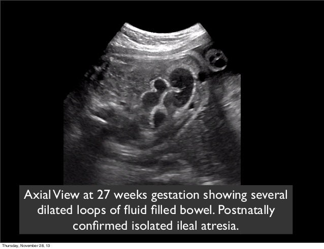 Sonography of fetal GIT