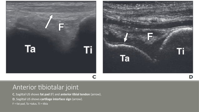 Sonography of the Normal Ankle - A Target Approach Using Skeletal ...