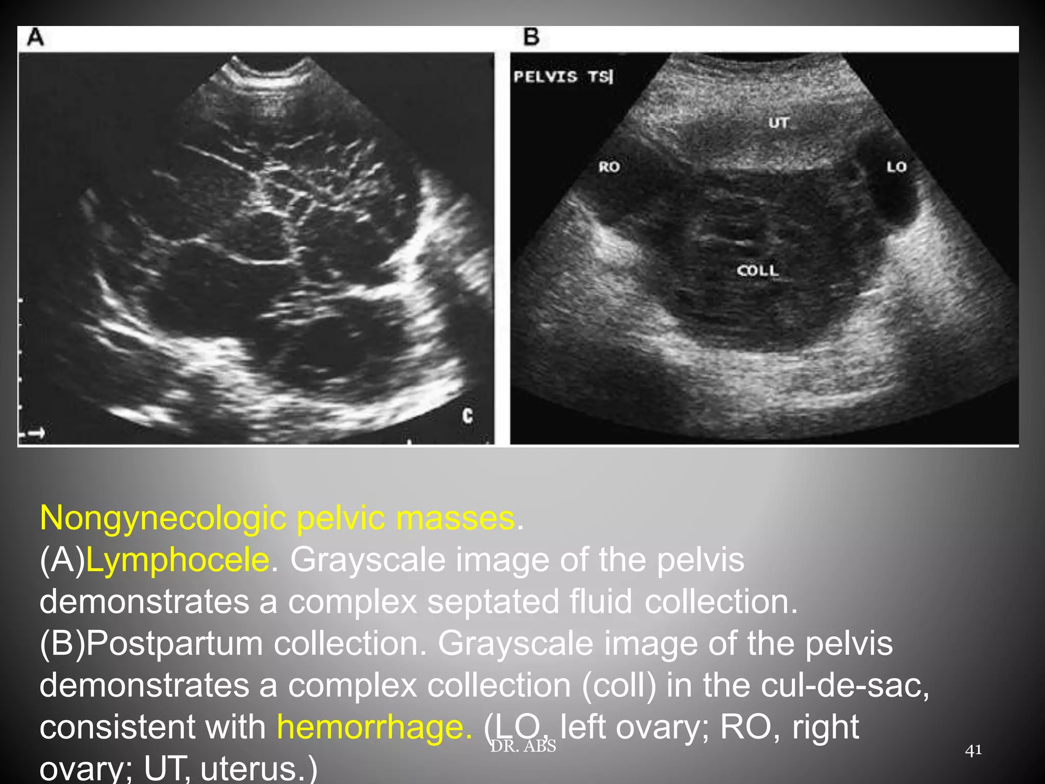 USG OF PELVIC MASSES BY DR ABHIJIT R SINGH | PPTX