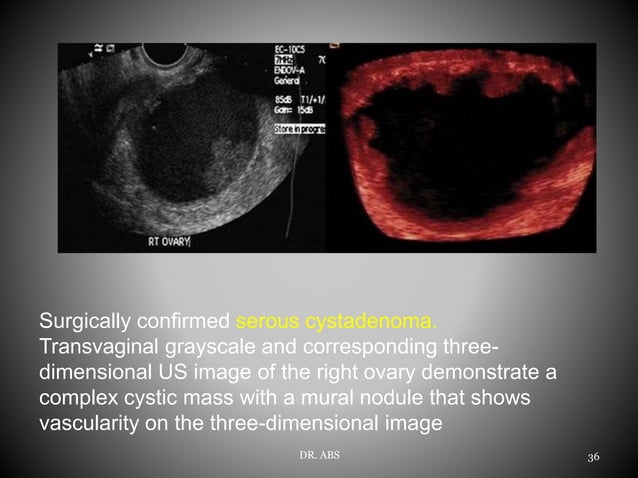 USG OF PELVIC MASSES BY DR ABHIJIT R SINGH | PPTX