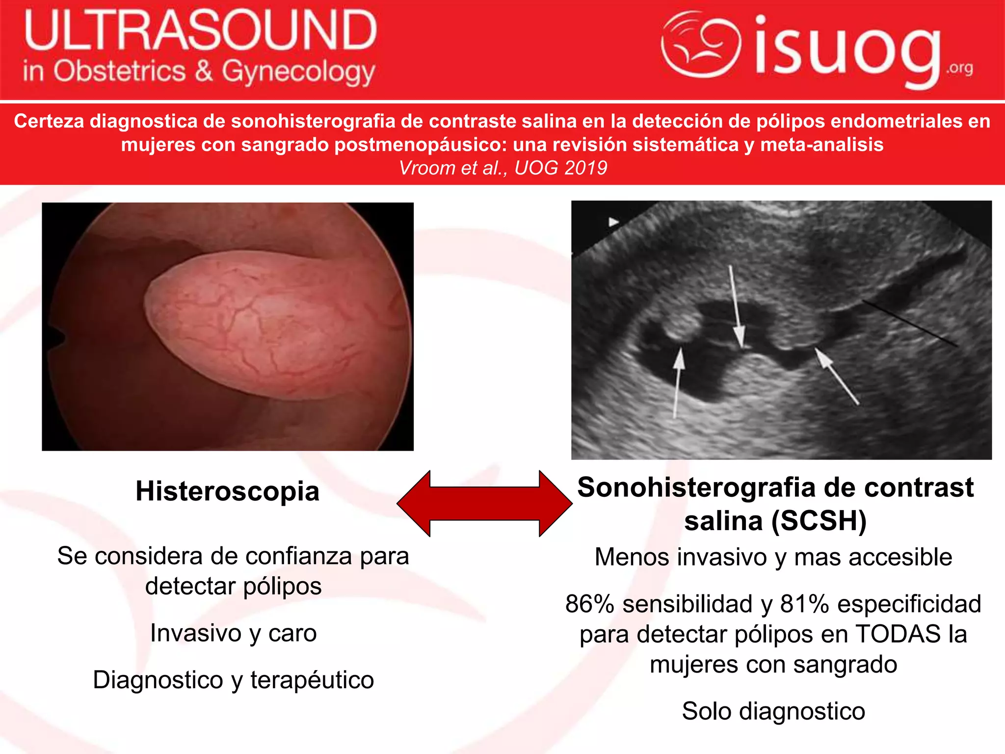Sonohisterografía Sangrado uterino.pptx