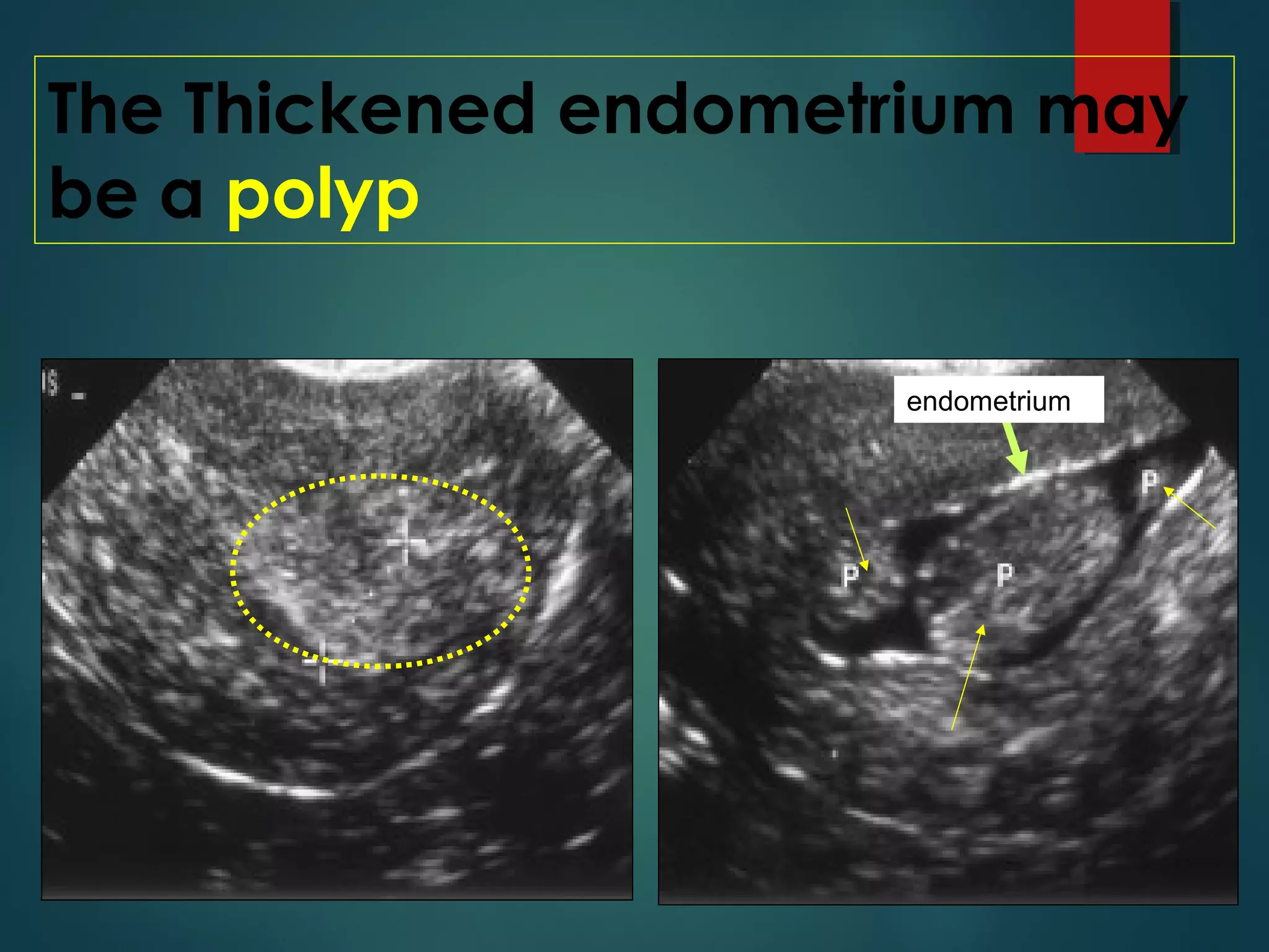 Sonohysterography | PPT