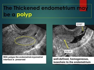 Sonohysterography | PPT