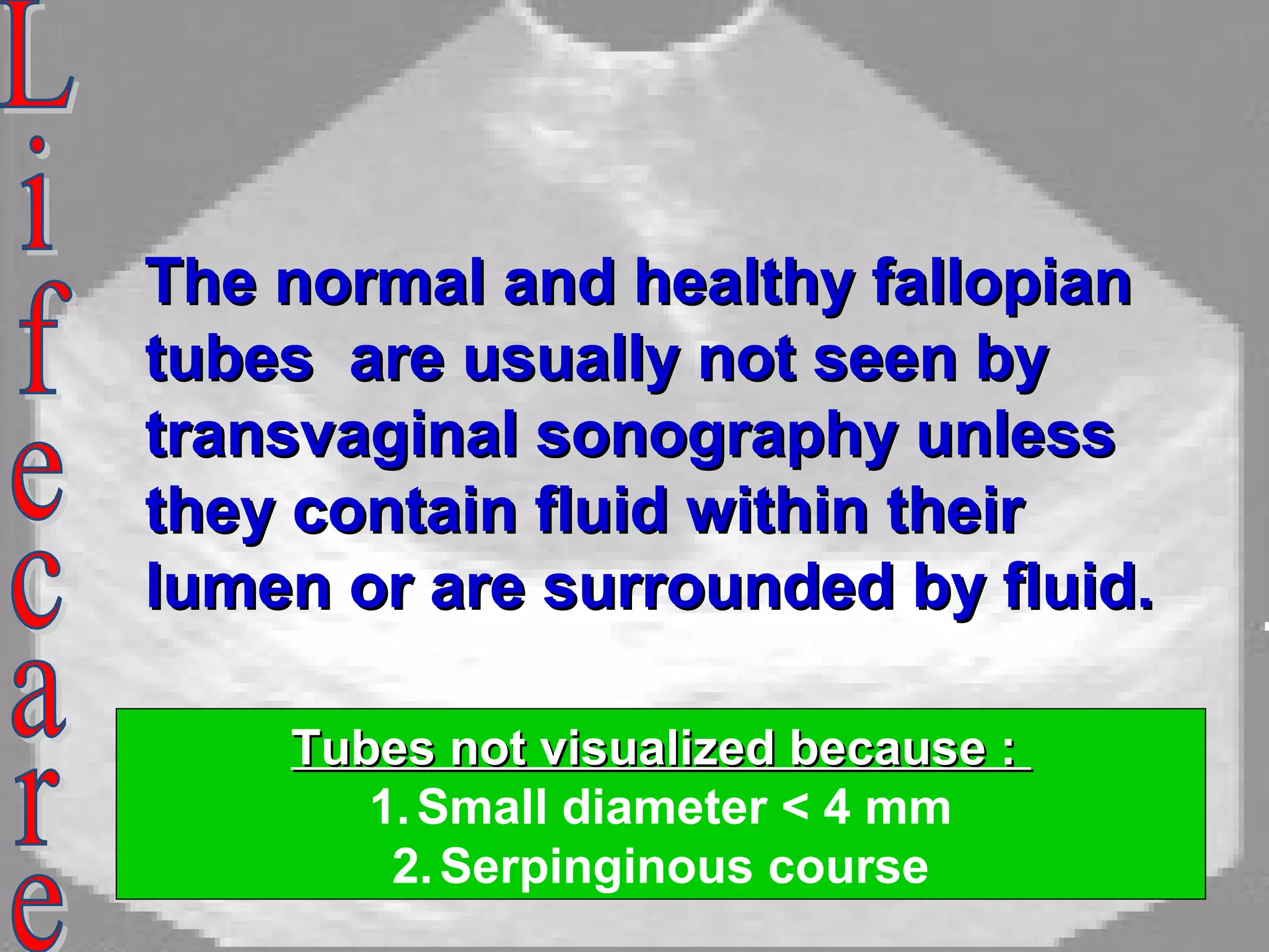 Sonosalpingography. Dr. Sharda Jain, Dr. Jyoti Agarwal | PPT