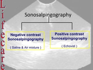 Sonosalpingography. Dr. Sharda Jain, Dr. Jyoti Agarwal | PPT
