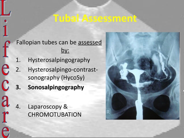 Sonosalpingography. Dr. Sharda Jain, Dr. Jyoti Agarwal | PPT