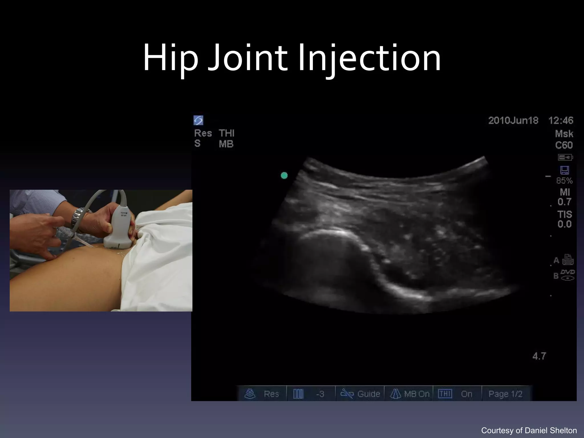 Ultrasound Guided Injections - Lower Extremity | PDF