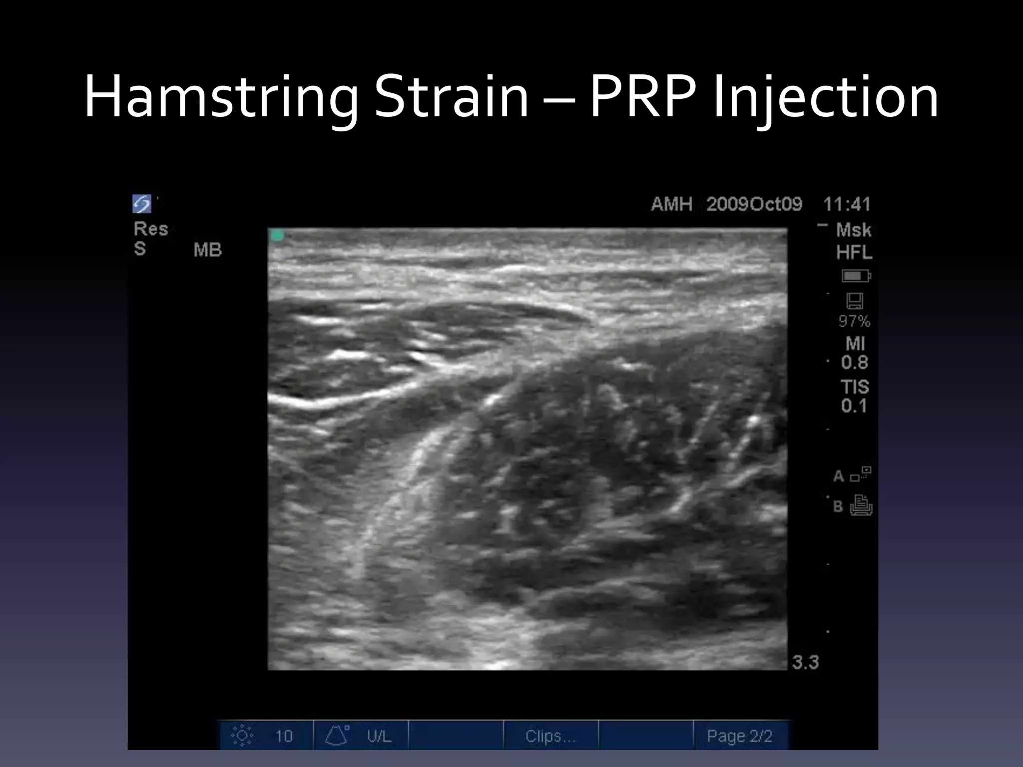 Ultrasound Guided Injections - Lower Extremity | PDF