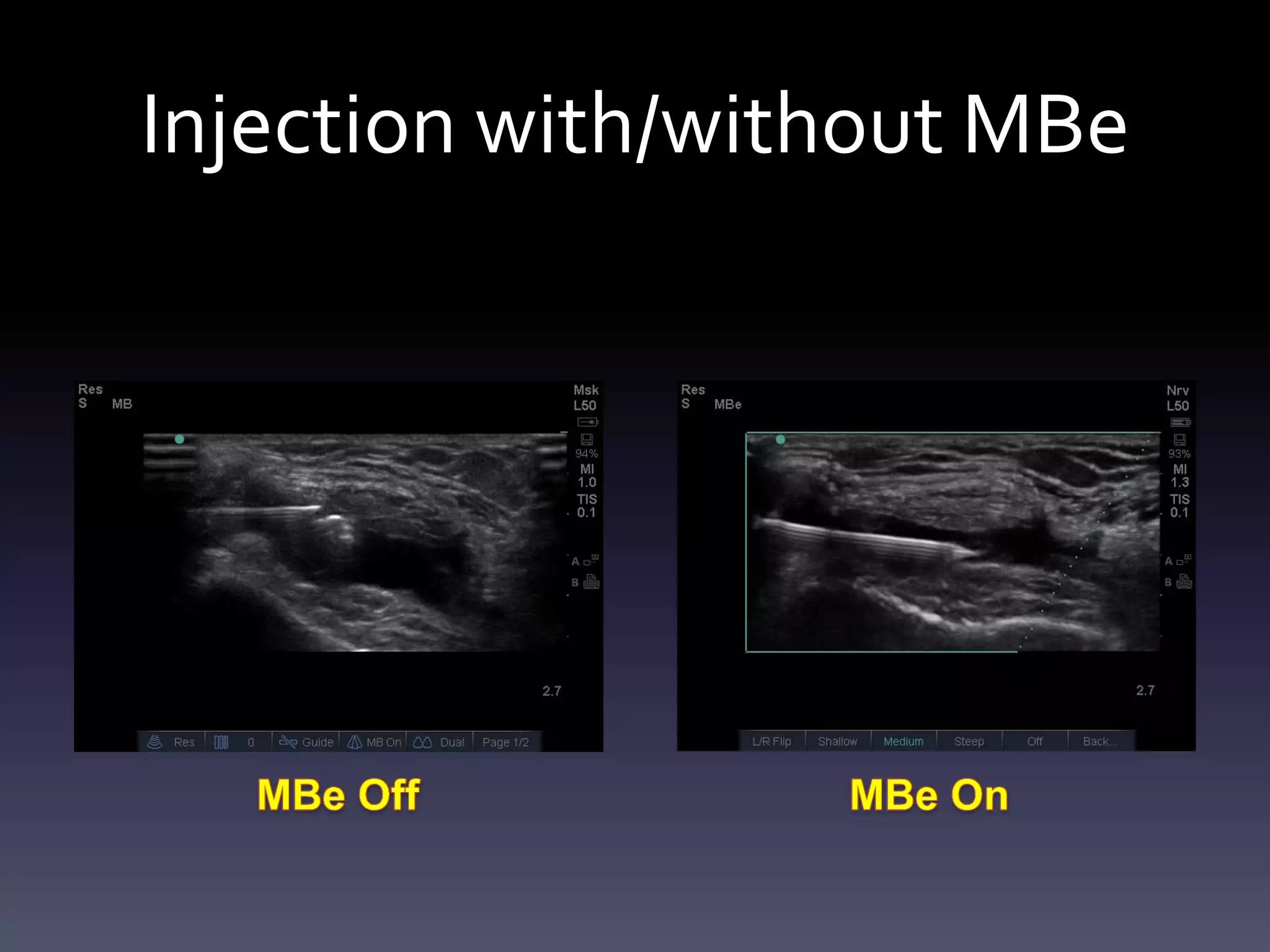 Ultrasound Guided Injections - Lower Extremity | PDF