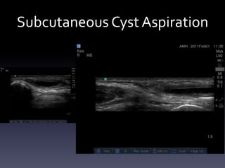 Ultrasound Guided Injections - Lower Extremity | PDF
