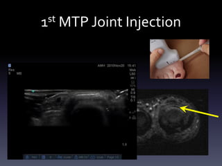 Ultrasound Guided Injections - Lower Extremity | PDF