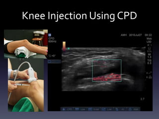 Ultrasound Guided Injections - Lower Extremity | PDF