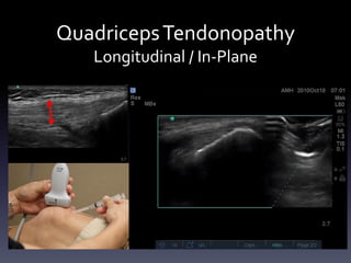 Ultrasound Guided Injections - Lower Extremity | PDF