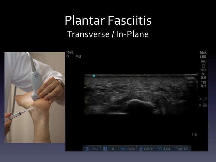 Ultrasound Guided Injections - Lower Extremity