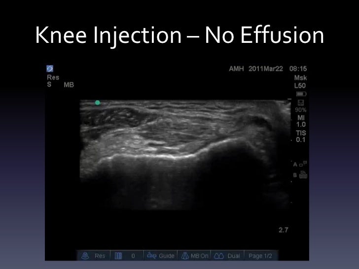 Ultrasound Guided Injections - Lower Extremity