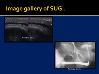 Sonourethrogram | PPT