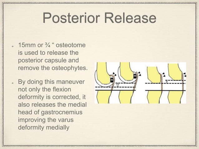 Correcting Varus Deformity of the Knee in Total Knee Replacement