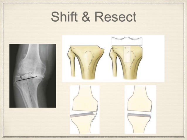 Correcting Varus Deformity of the Knee in Total Knee Replacement