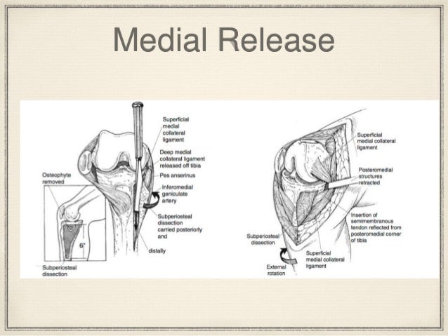 Correcting Varus Deformity of the Knee in Total Knee Replacement