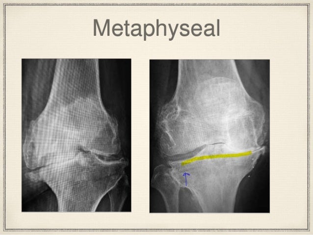 Correcting Varus Deformity of the Knee in Total Knee Replacement
