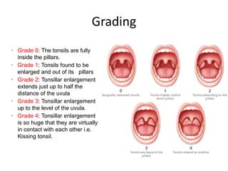 Tonsillitis Grading