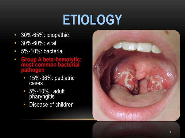 Sore throat and streptococcal pharyngitis | PPTX | Ear, Nose and Throat ...