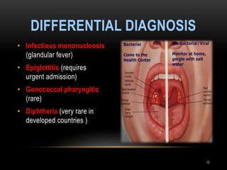 Streptococcal Pharyngitis