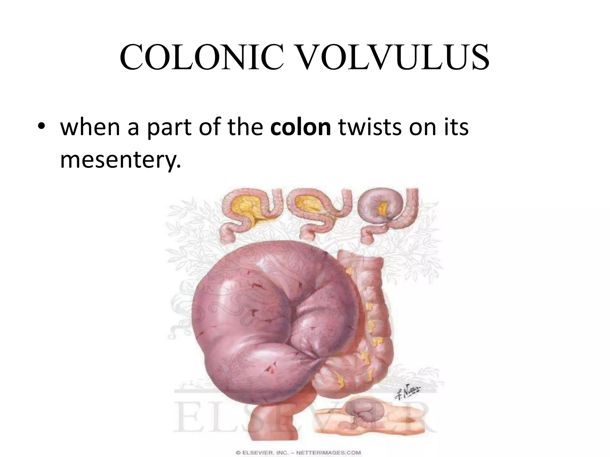 COLONOSCOPIC VOLVULUS DEFLATION | PPT