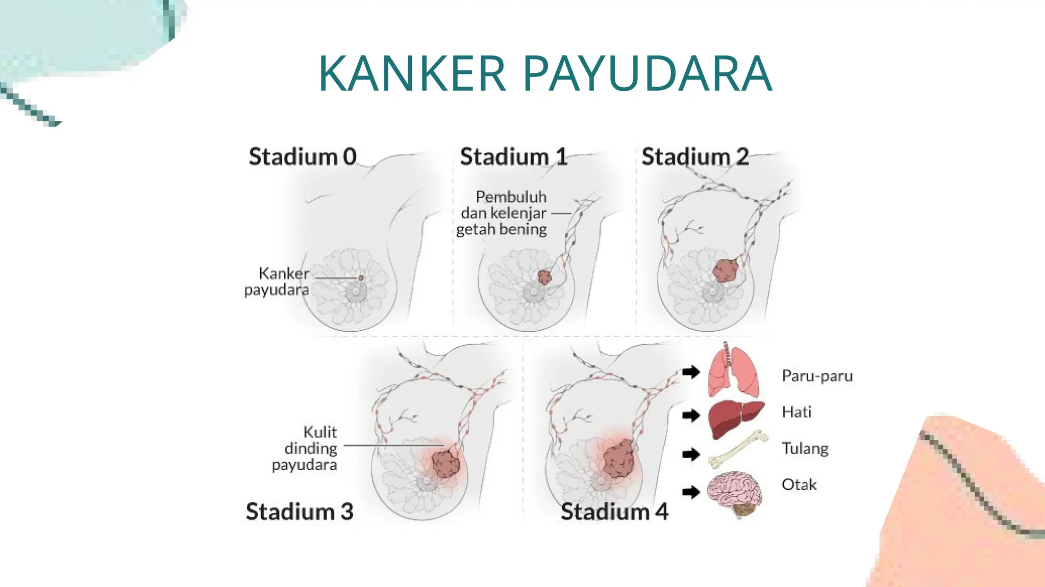 Sosialisasi Ca Cervix dan Ca Mammae 31122023.pptx