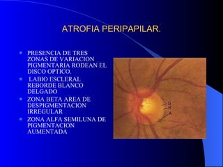 Sospecha De Glaucoma | PPT