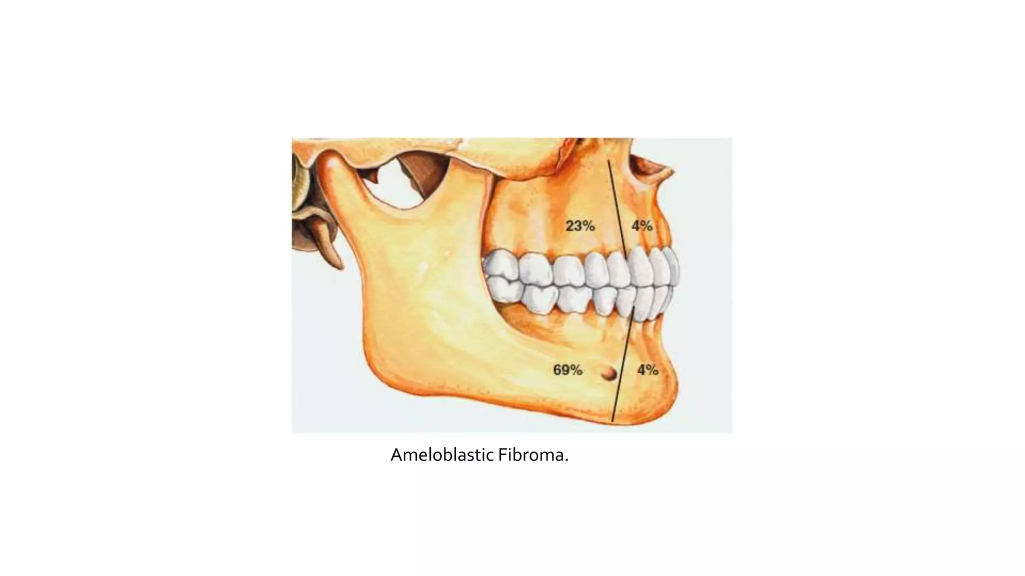 1. Ameloblastic fibroma 2. Odontoma 3. Squamous odontogenic tumor | PPTX