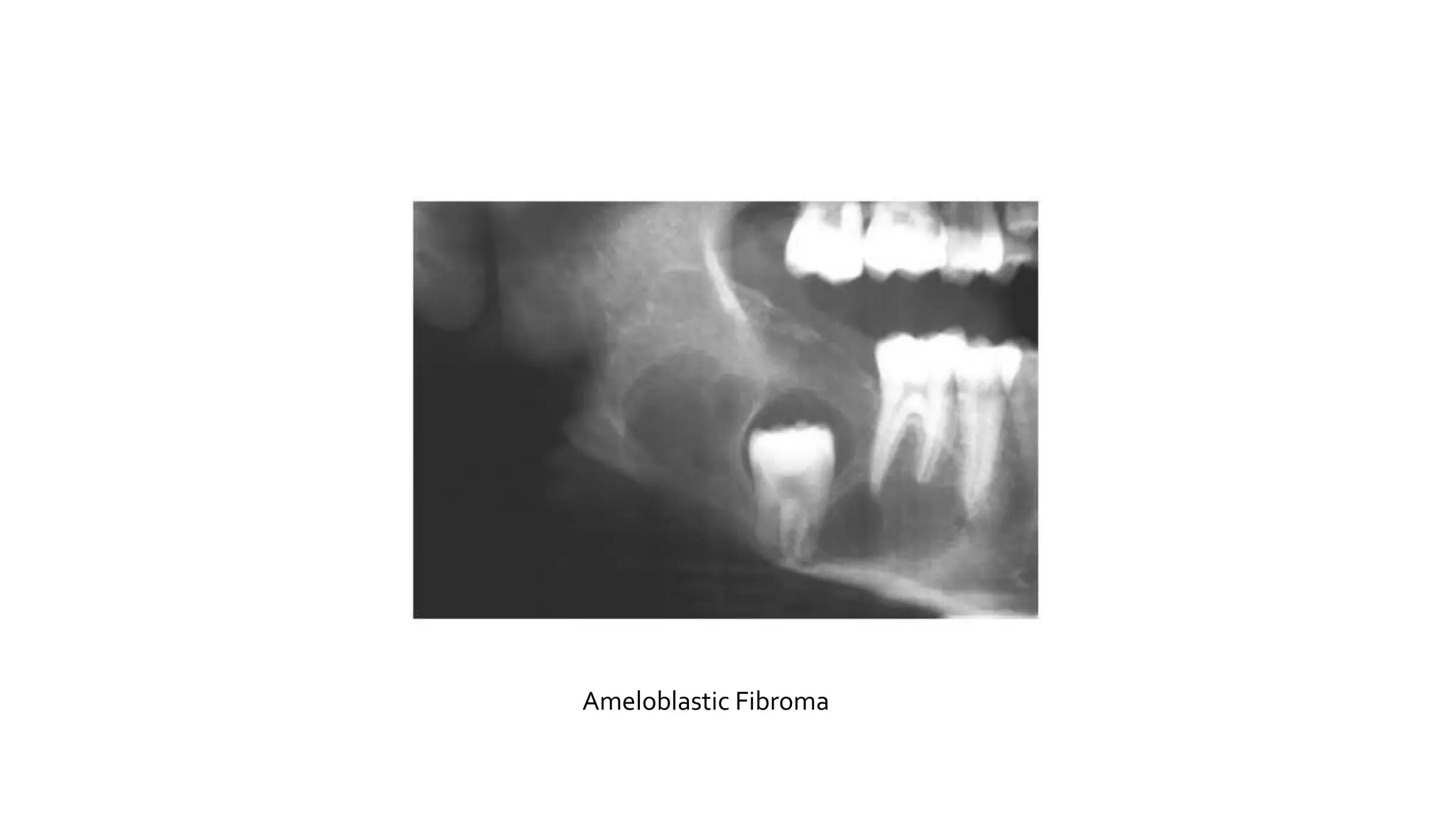 1. Ameloblastic fibroma 2. Odontoma 3. Squamous odontogenic tumor | PPTX