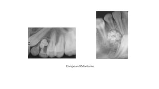 1. Ameloblastic fibroma 2. Odontoma 3. Squamous odontogenic tumor | PPTX