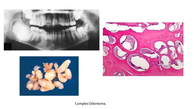 1. Ameloblastic fibroma 2. Odontoma 3. Squamous odontogenic tumor | PPTX