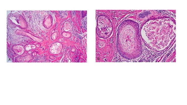 1. Ameloblastic fibroma 2. Odontoma 3. Squamous odontogenic tumor | PPTX